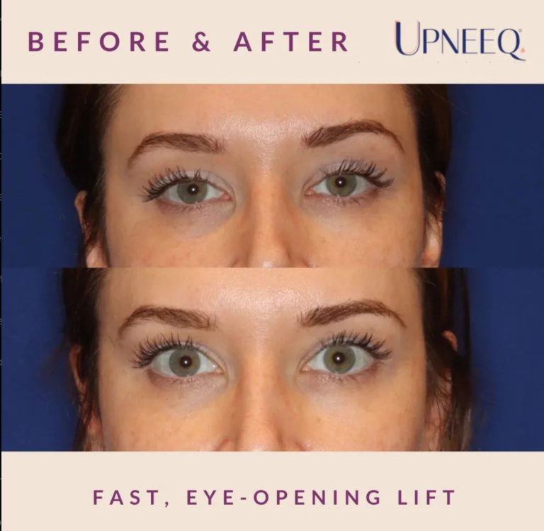 UPNEEQ® (oxymetazoline hydrochloride ophthalmic solution)