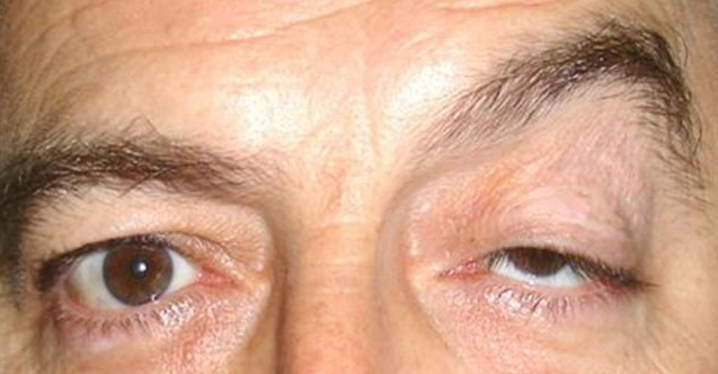 Upneeq: A Possible Solution for Ptosis Post-Stroke or Palsy - UPNEEQ